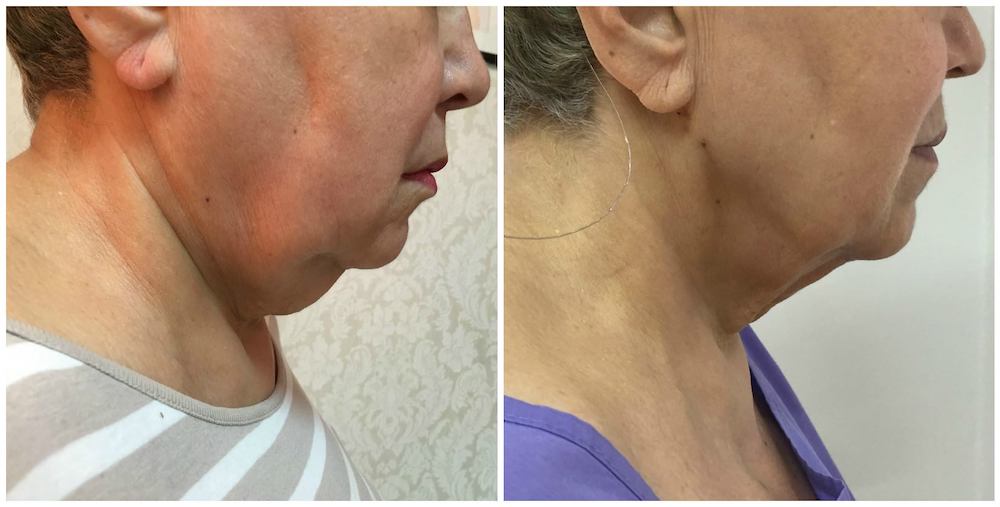 Lipoaspirație laser » ProLipo Plus » Dr. Dana Miricioiu