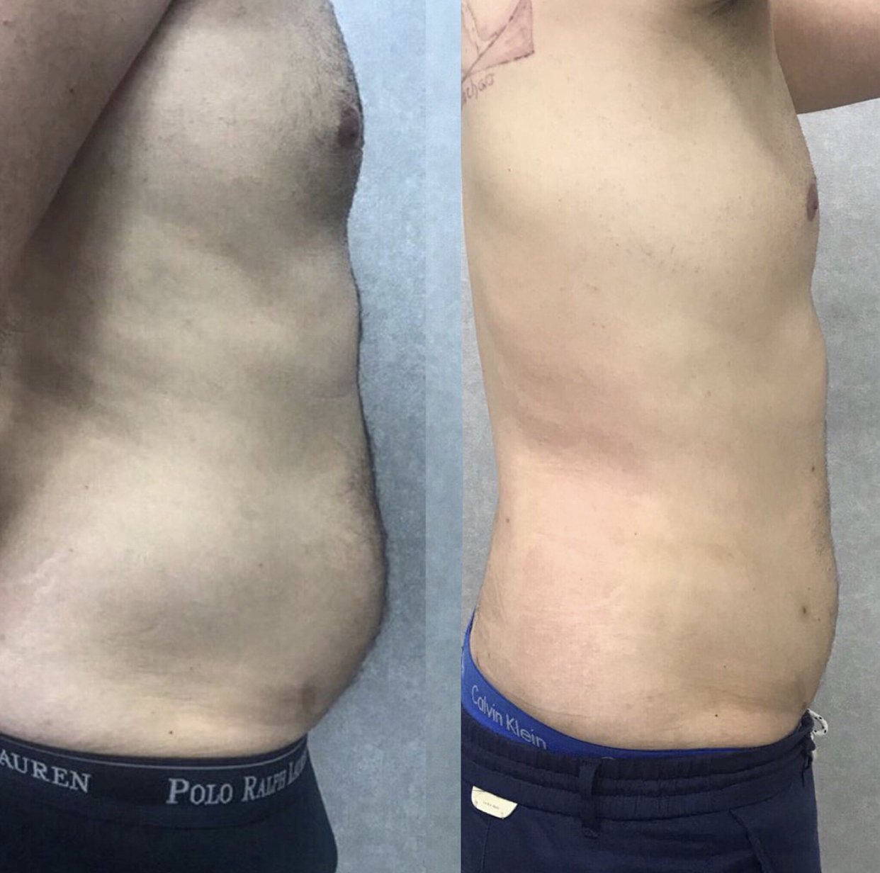 Lipoaspirație laser » ProLipo Plus » Dr. Dana Miricioiu