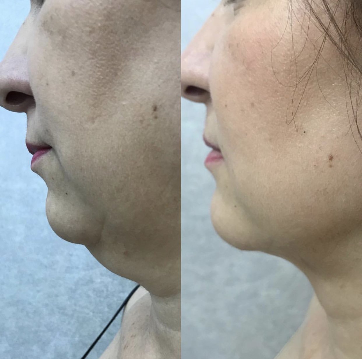 Lipoaspirație laser » ProLipo Plus » Dr. Dana Miricioiu