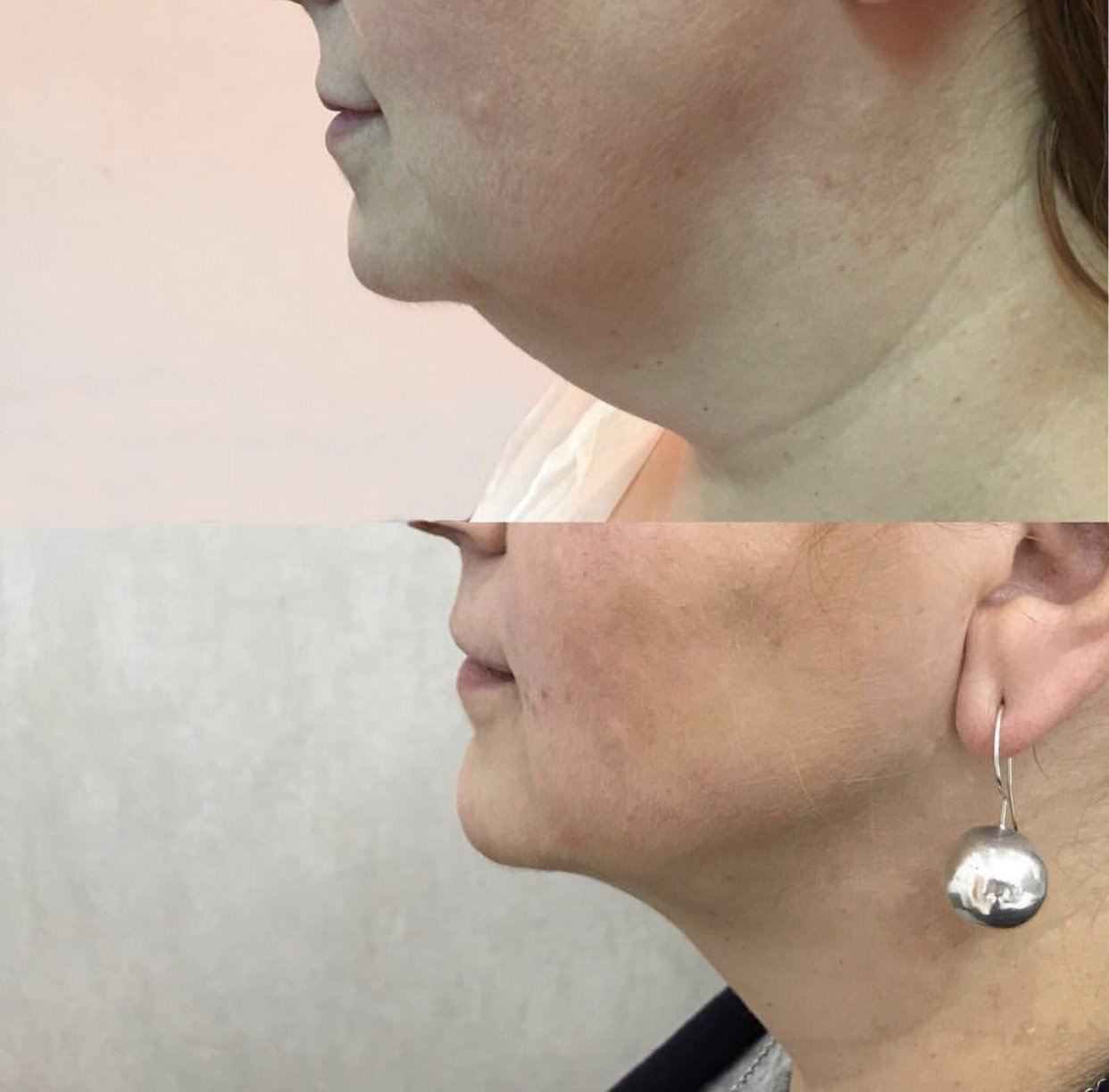 Lipoaspirație laser » ProLipo Plus » Dr. Dana Miricioiu