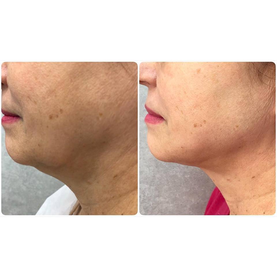 Lipoaspirație laser » ProLipo Plus » Dr. Dana Miricioiu