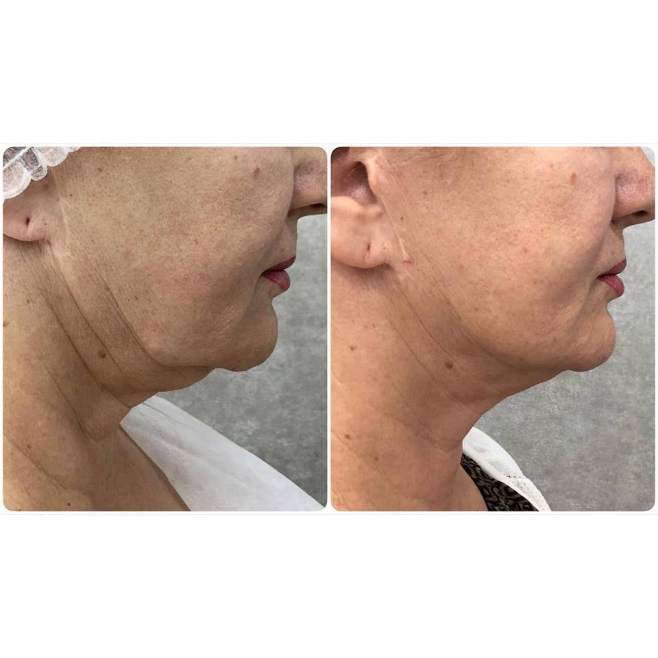 Lipoaspirație laser » ProLipo Plus » Dr. Dana Miricioiu