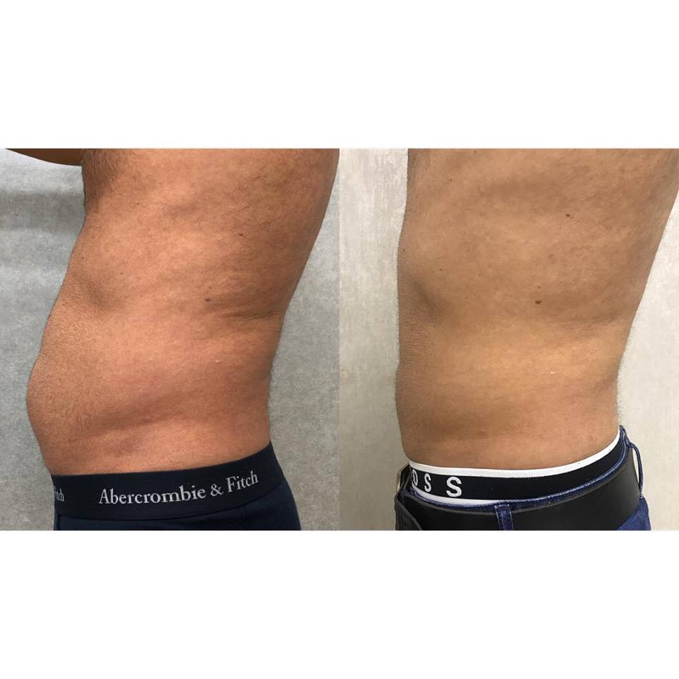 Lipoaspirație laser » ProLipo Plus » Dr. Dana Miricioiu