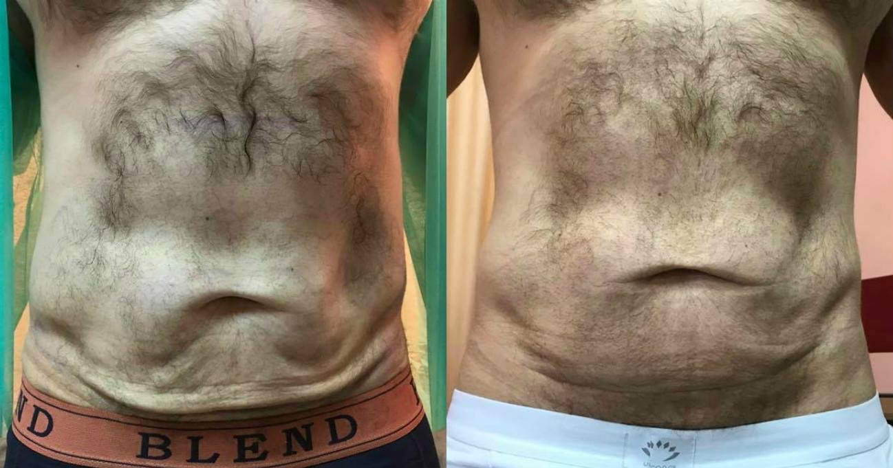 Lipoaspirație laser » ProLipo Plus » Dr. Dana Miricioiu