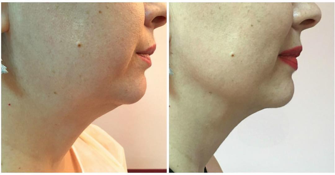 Lipoaspirație laser » ProLipo Plus » Dr. Dana Miricioiu