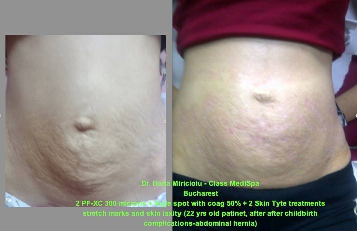 Tratament vergeturi cu laser » Dr. Dana Miricioiu